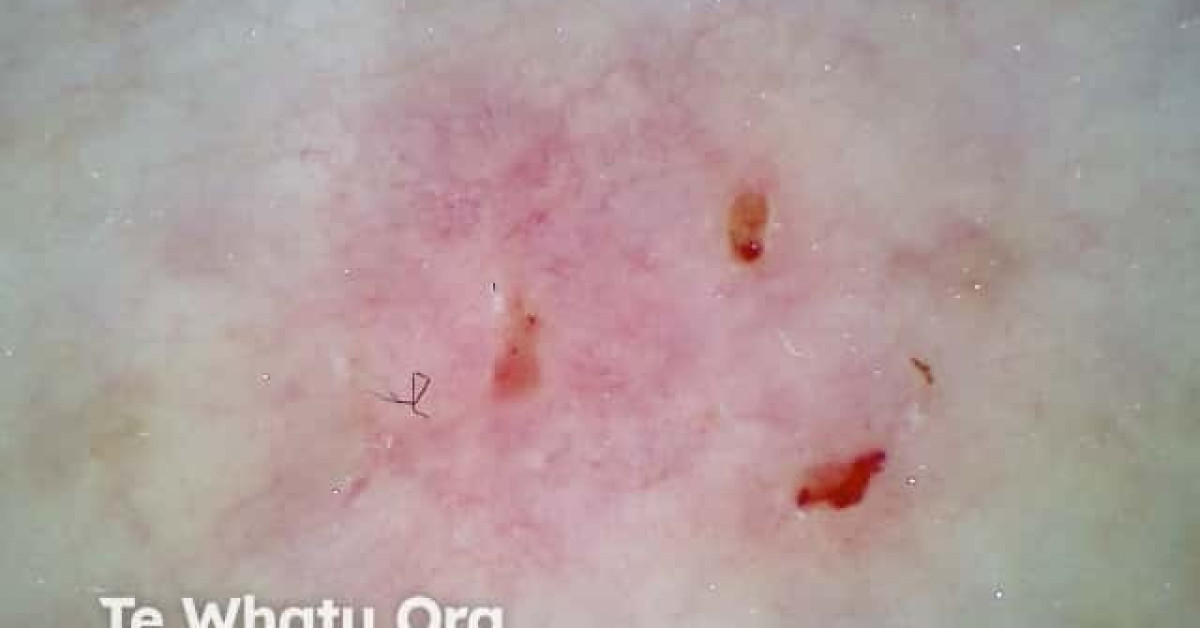 Nonpolarised dermoscopy of basal cell carcinoma image