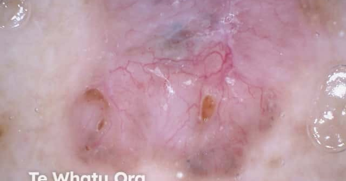 Nonpolarised dermoscopy of pigmented basal cell carcinoma image