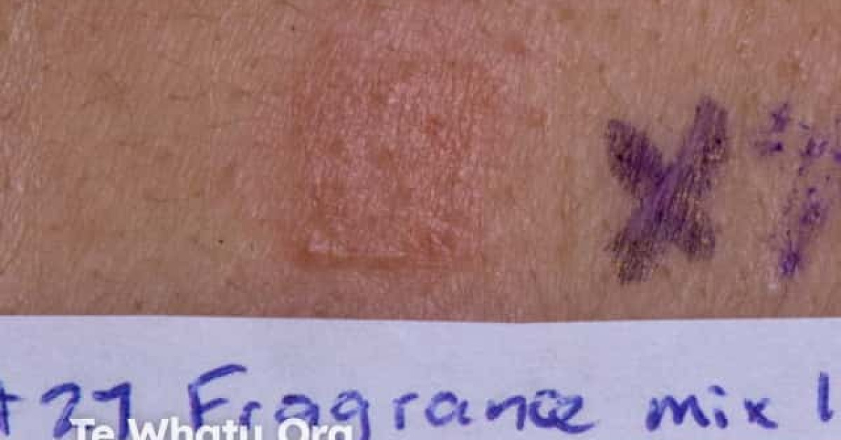 Positive patch test to fragrance image