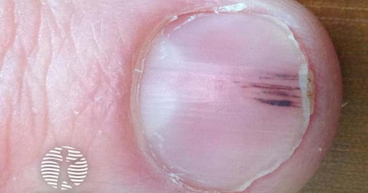 Onychopapilloma image