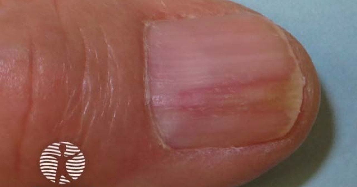 Onychopapilloma image