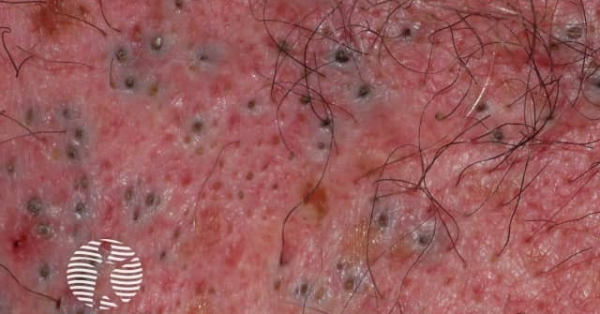 Open comedones image