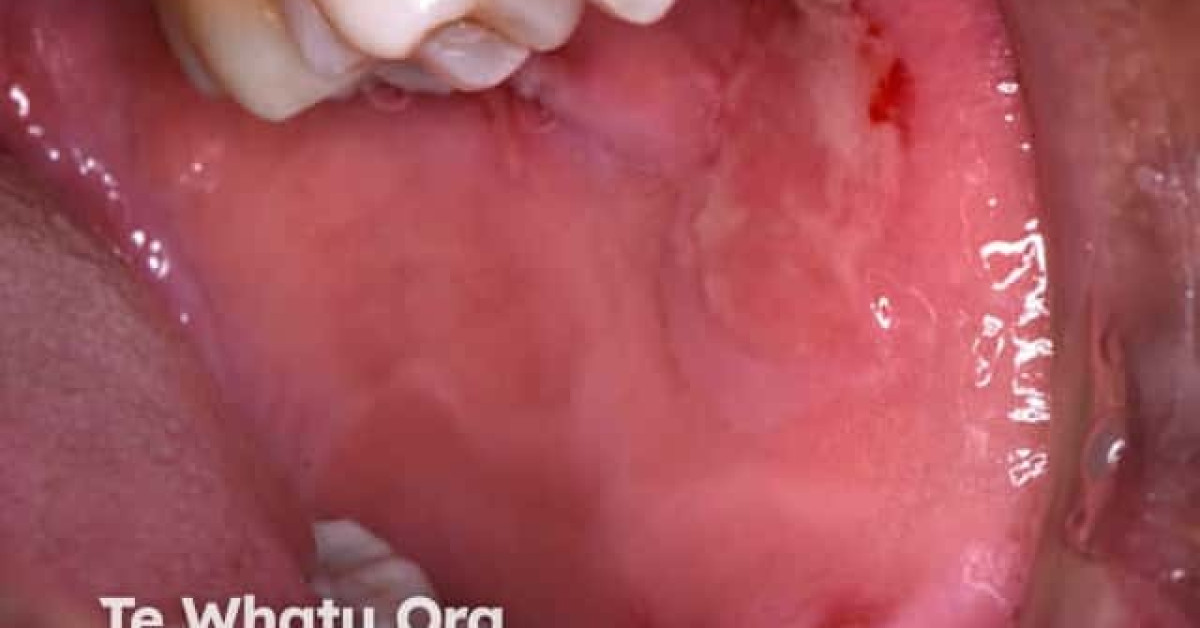 Oral pemphigus vulgaris image
