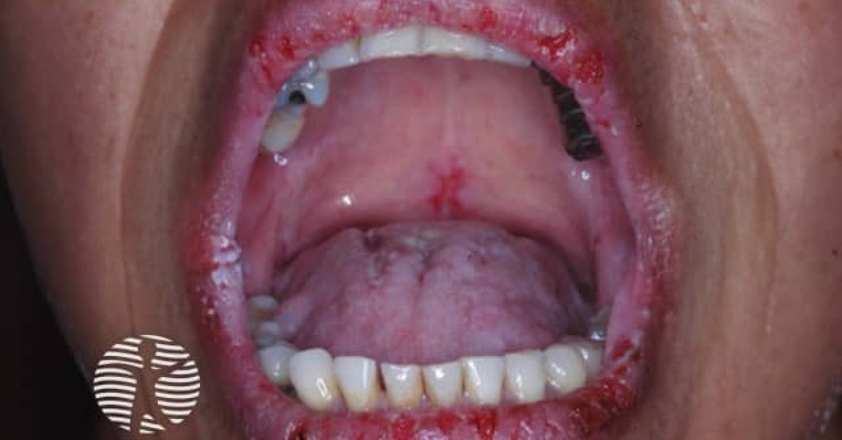 Oral pemphigus vulgaris image