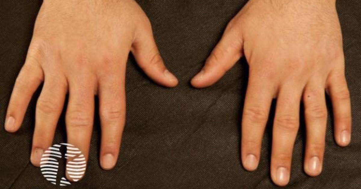 Pachydermodactyly image