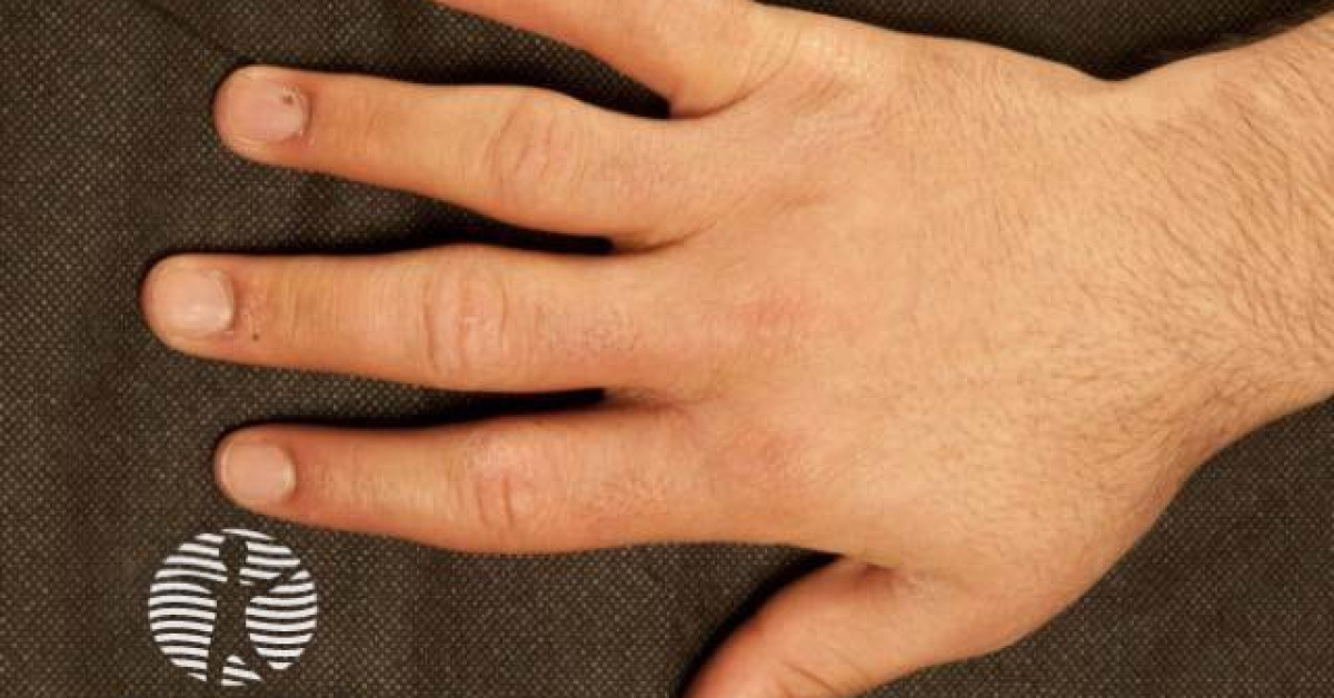 Pachydermodactyly image