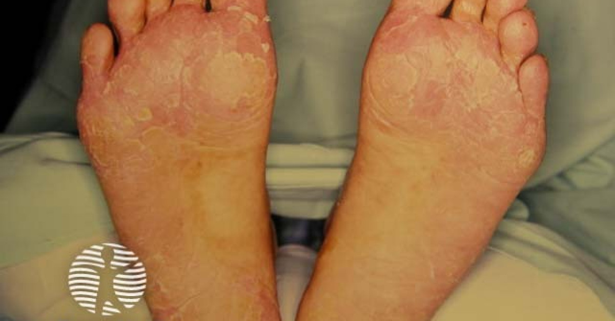 Plantar Keratoderma Image