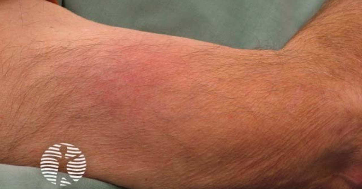 Staphylococcal panniculitis image