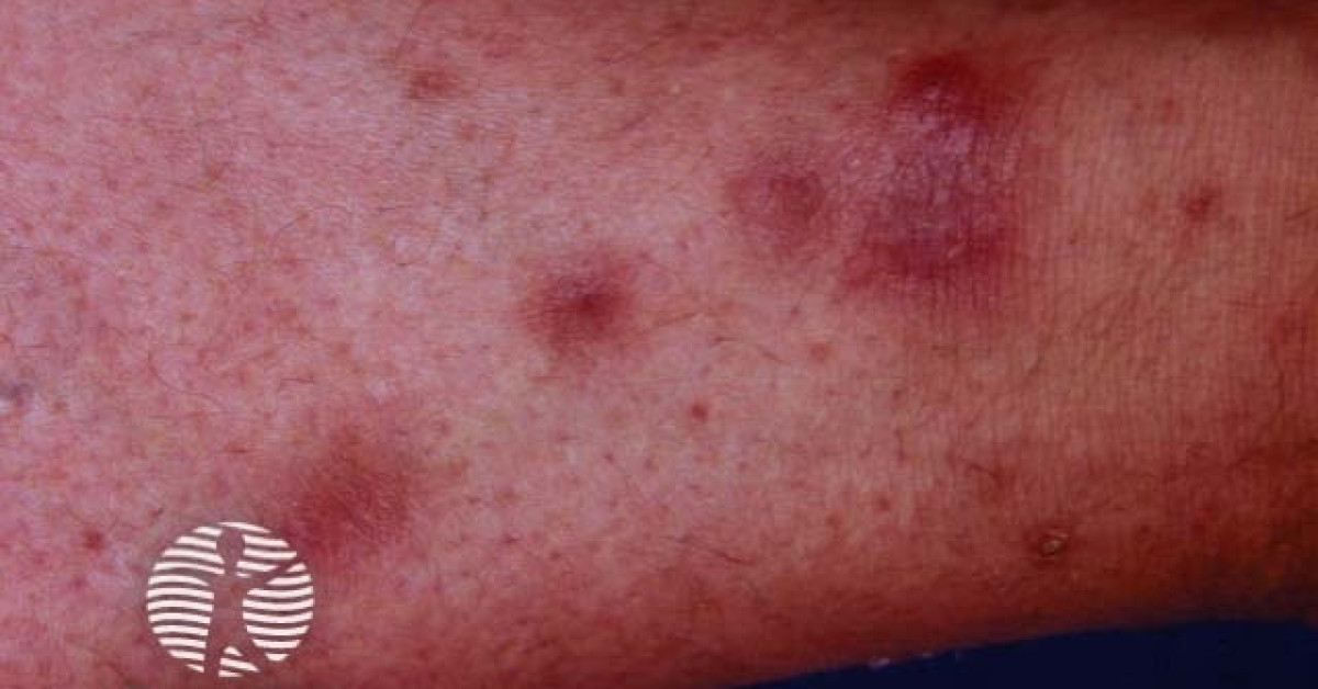 Infective panniculitis image
