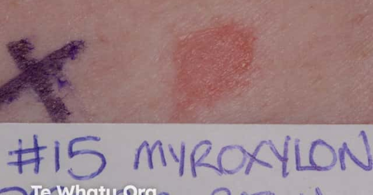 Positive patch test to balsam of Peru image