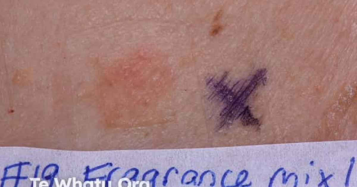 Positive patch test to fragrance mix I image