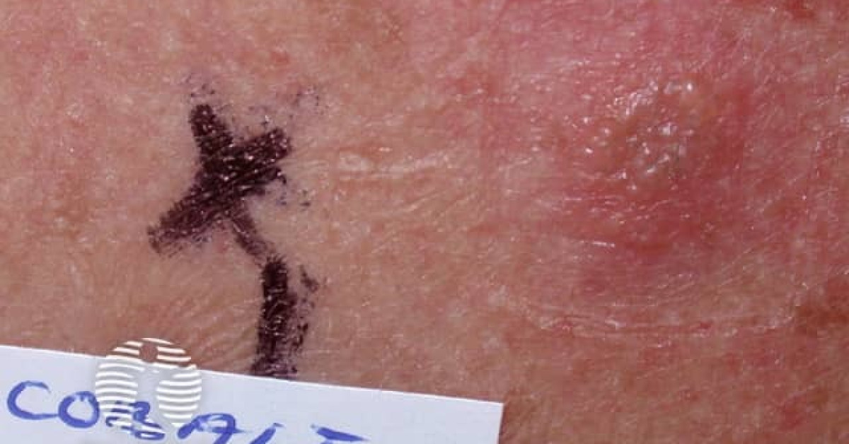 Positive patch test to cobalt image