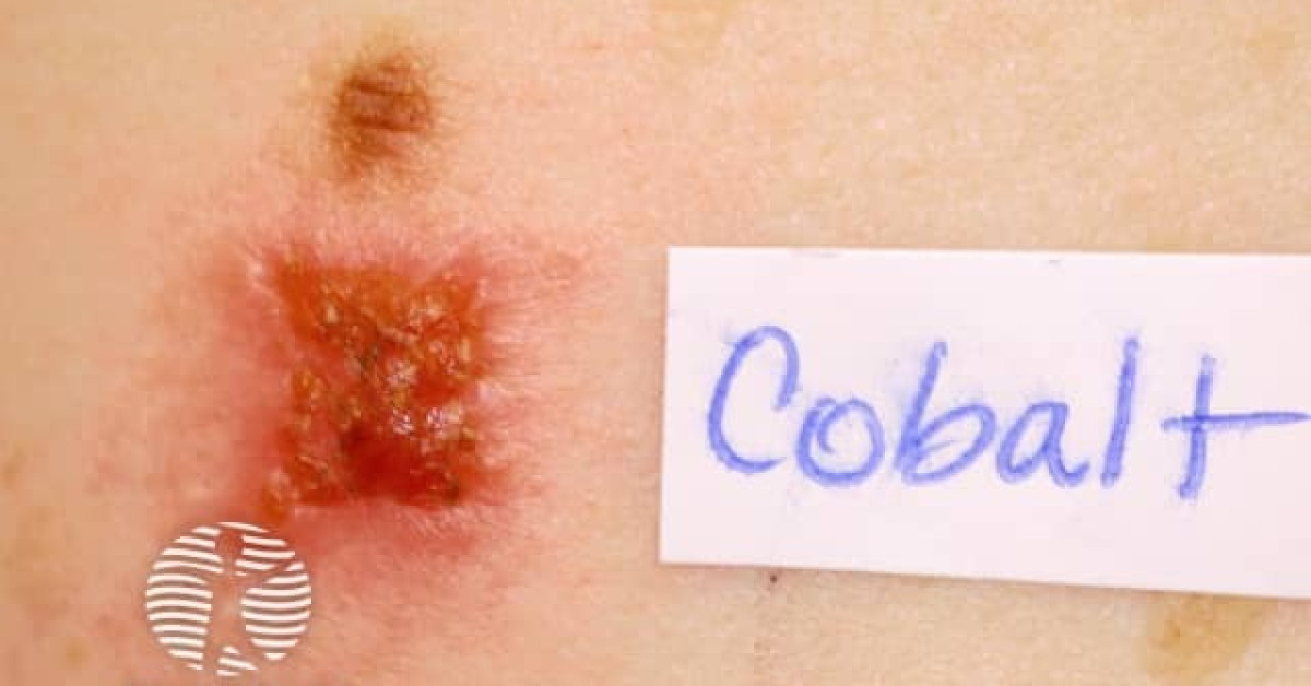 Positive patch test to cobalt image