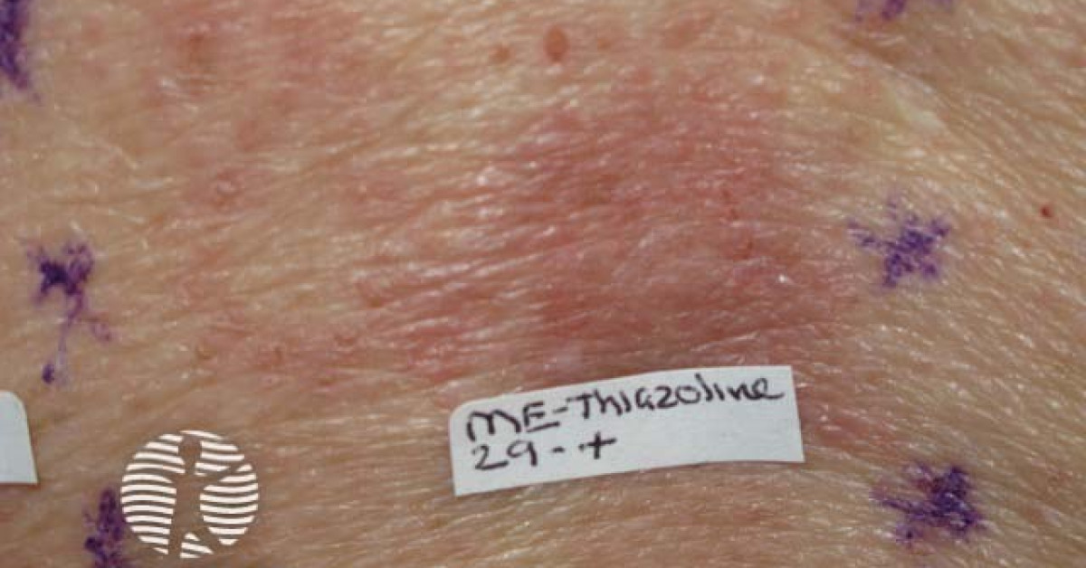 Positive patch test to methylisothiazolinone image