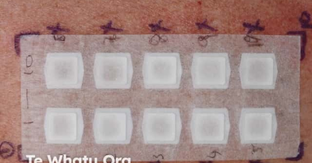 Patch tests applied to skin of upper back image