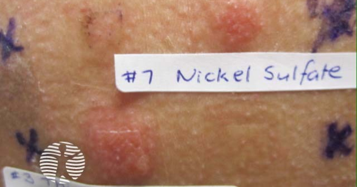 Positive patch test reaction to nickel, thiuram image