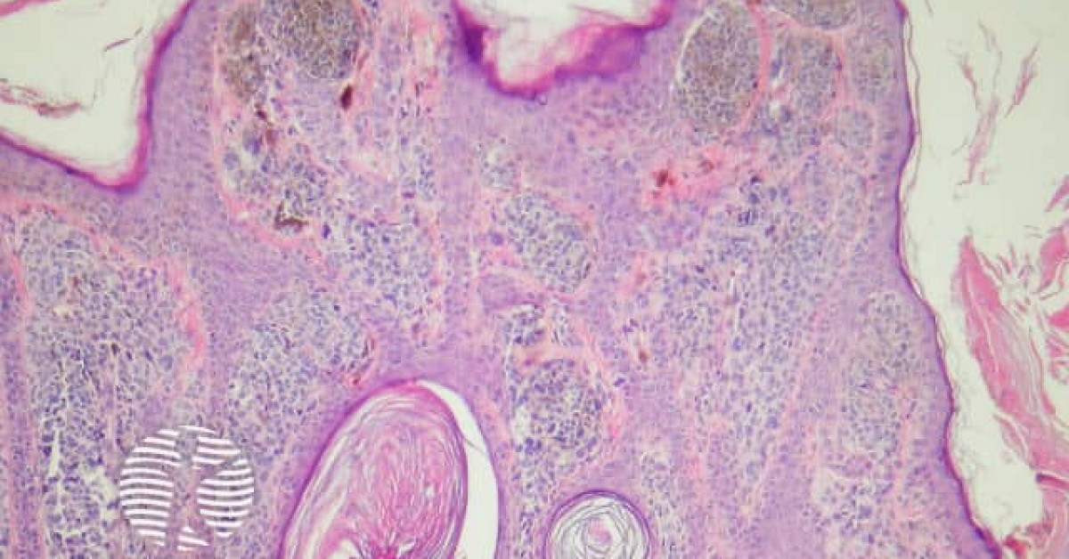 Pathology of compound naevus image