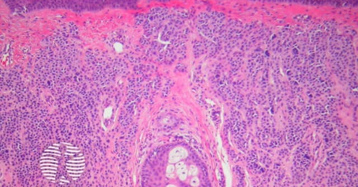 Pathology of intradermal naevus image