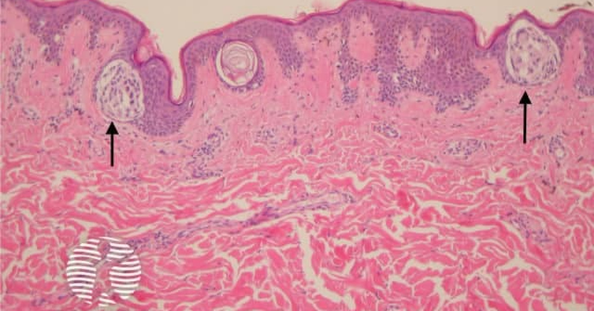 Pathology of junctional naevus image