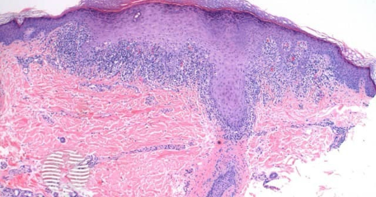 Pathology of lichen planus image