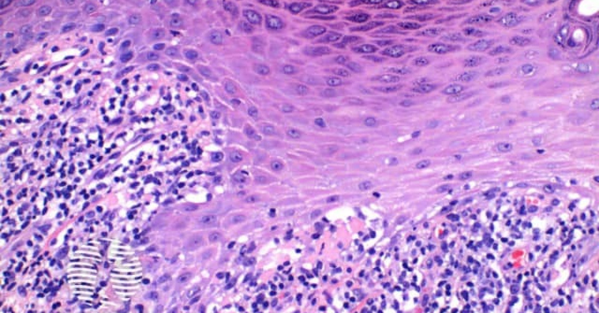 Pathology of lichen planus image