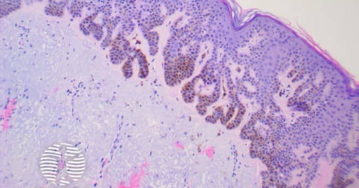 Pathology of pigmented seborrhoeic keratosis image