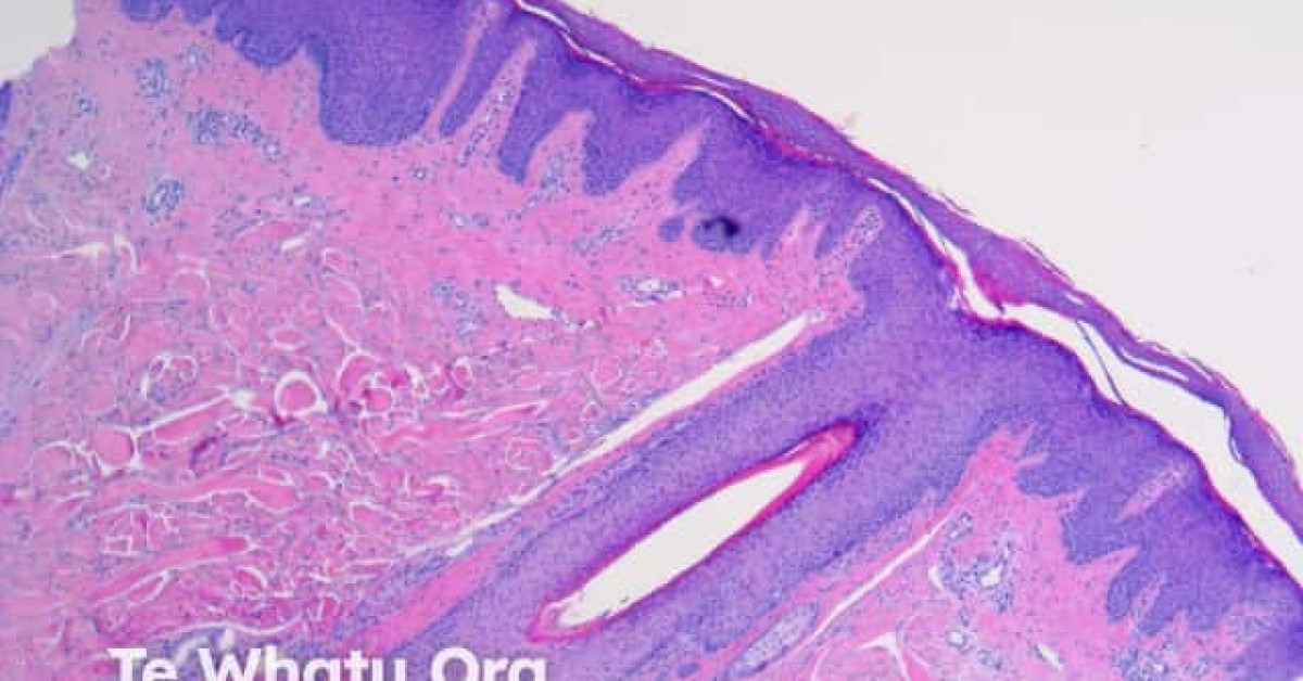 Pathology of psoriasis x40 image