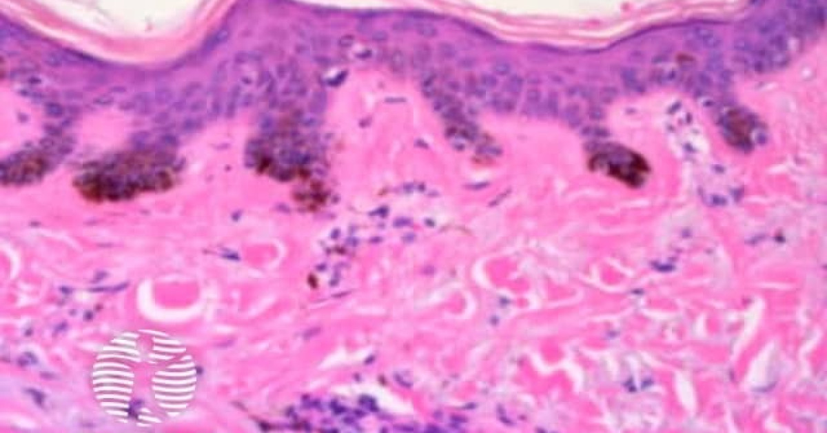 Pathology of solar lentigo image