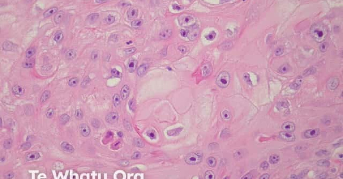 Pathology of squamous cell carcinoma keratinisation image