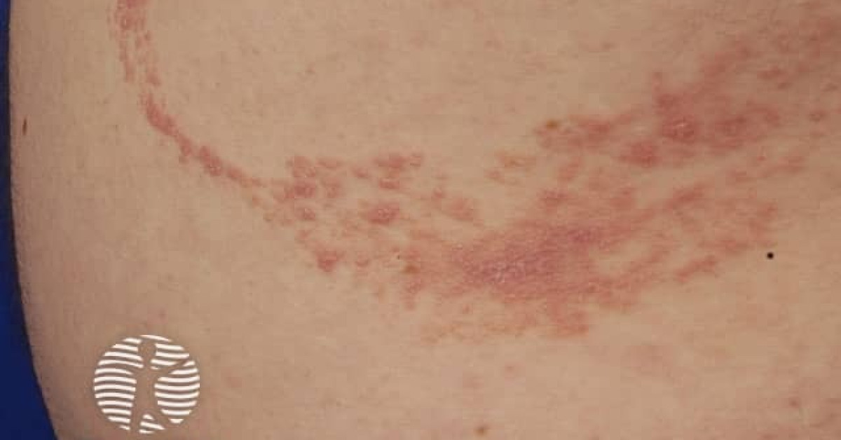 Lichen planus in Blaschko distribution image