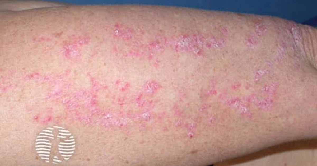 Psoriasis in Blaschko distribution image