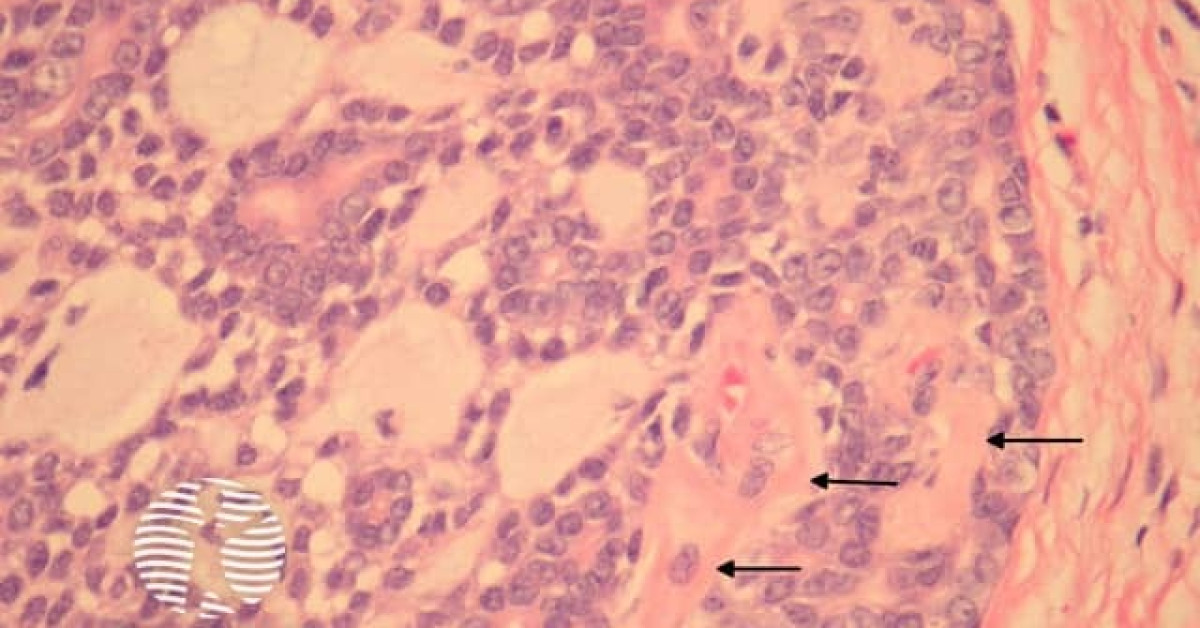Adenoid cystic carcinoma pathology image