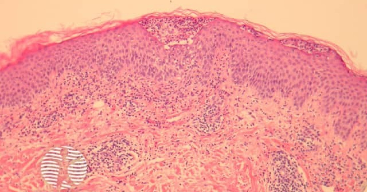 Acute Generalised Exanthematous Pustulosis (AGEP) pathology image