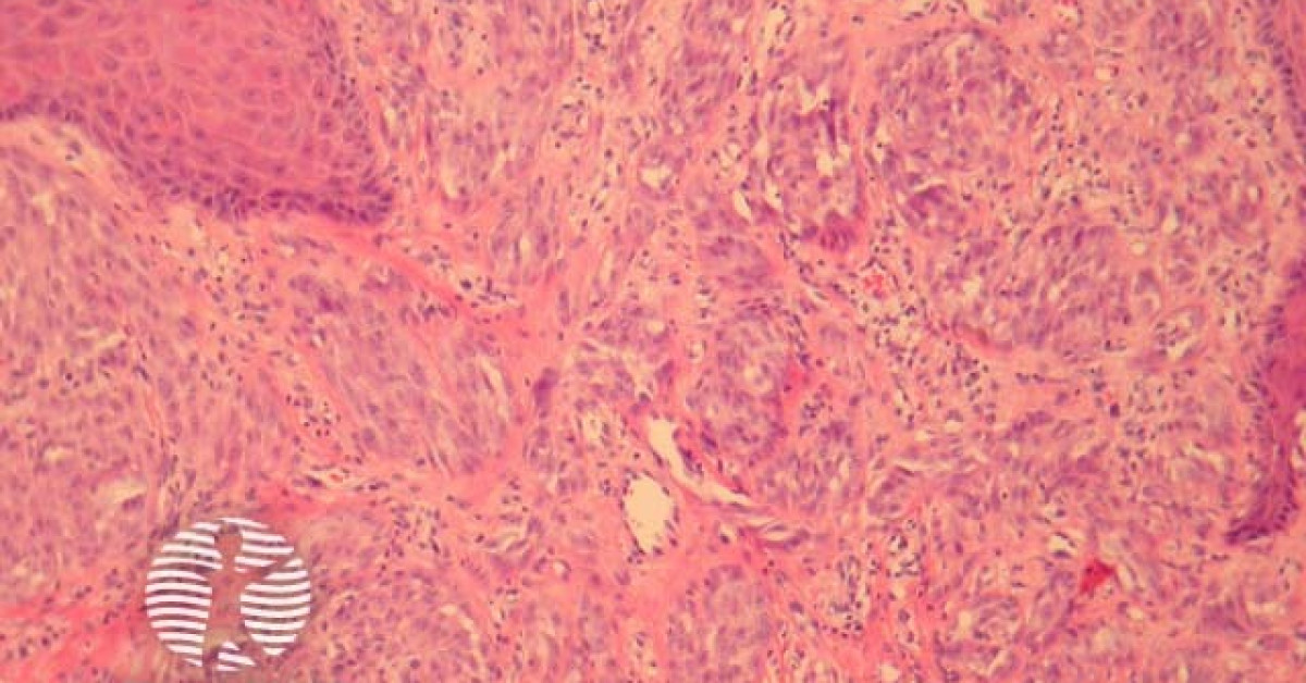 Pigmented spindle cell naevus of Reed pathology image