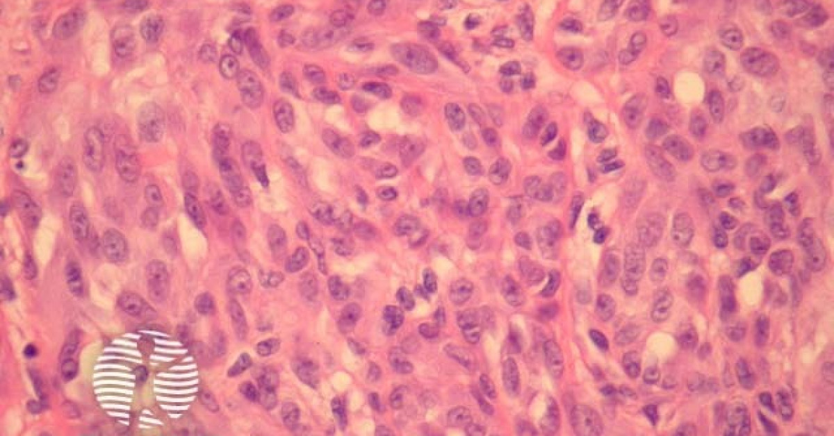 Pigmented spindle cell naevus of Reed pathology image
