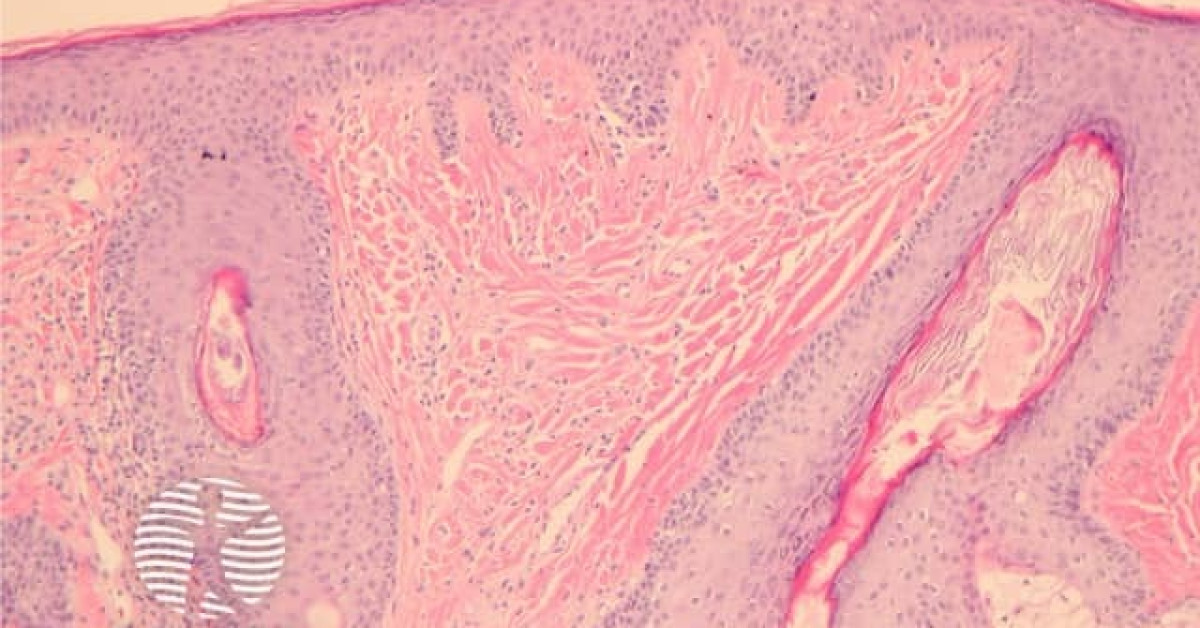 Angiofibroma pathology image