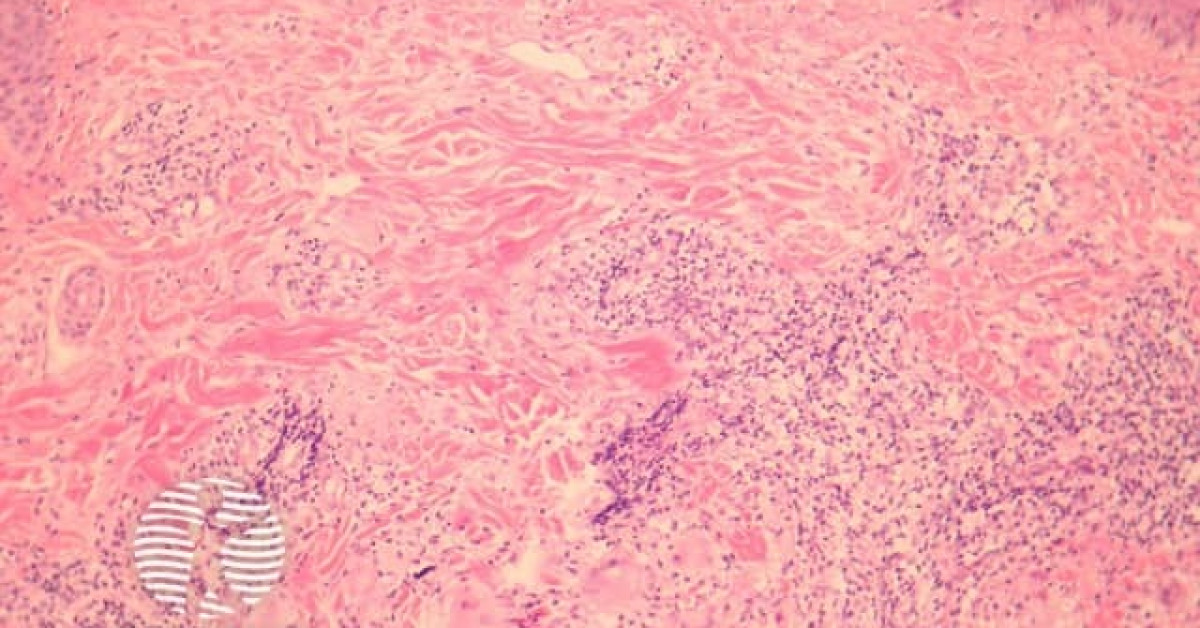 Annular elastolytic giant cell granuloma pathology image