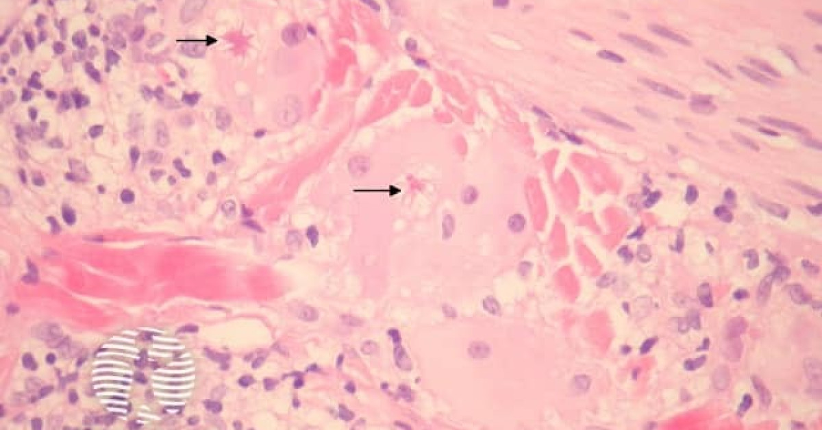 Annular elastolytic giant cell granuloma pathology image