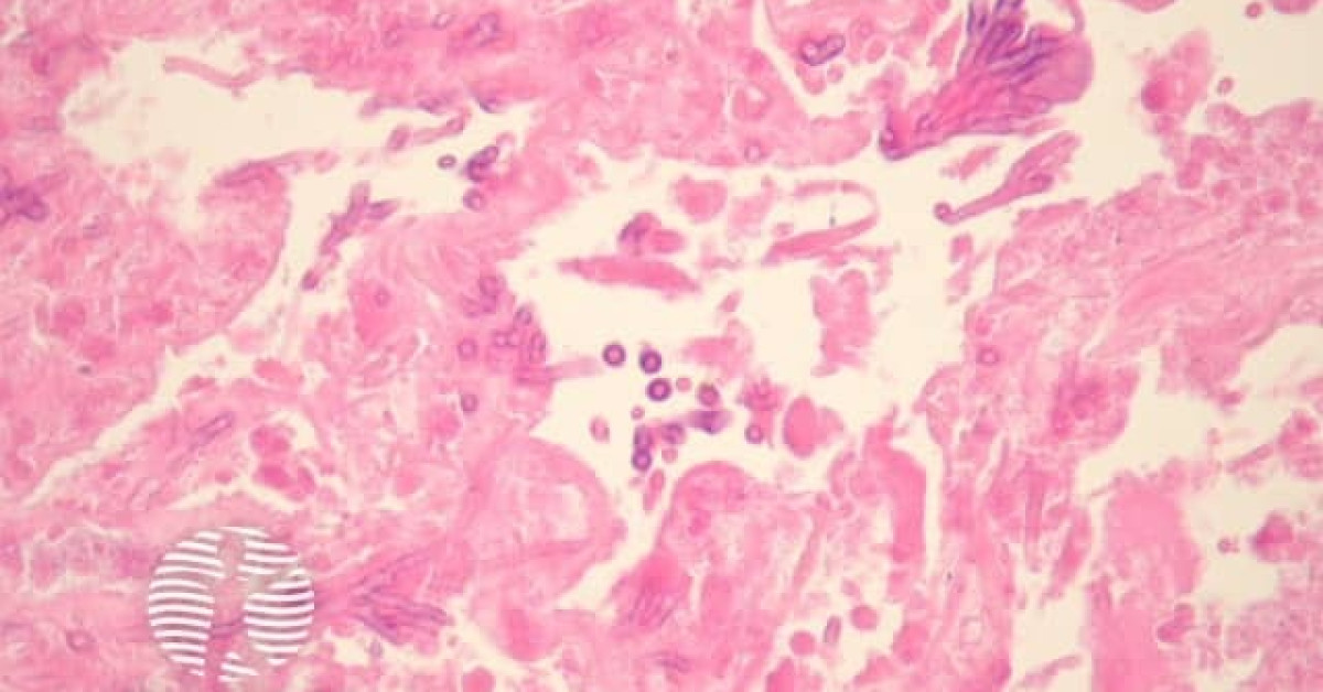 Aspergillosis pathology image