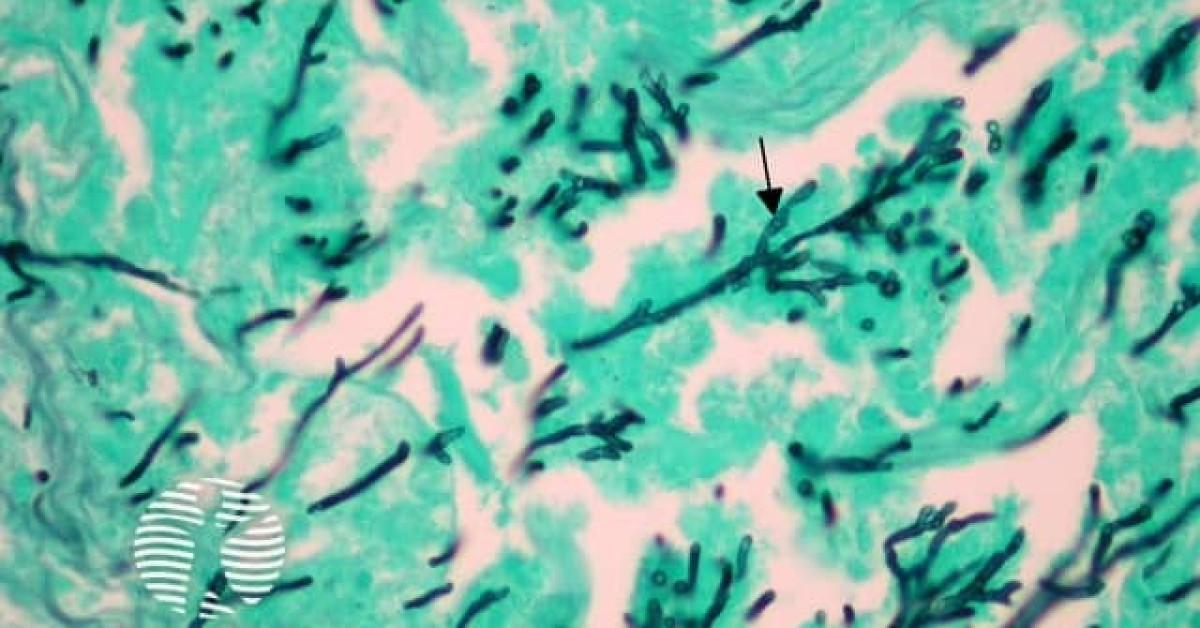 Aspergillosis pathology image