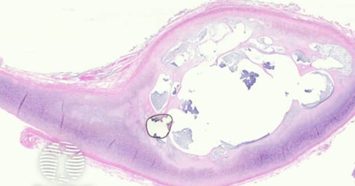 Auricle pseudocyst pathology image