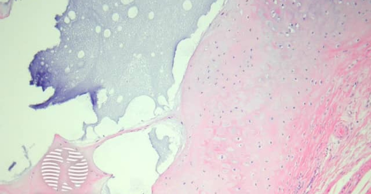 Auricle pseudocyst pathology image