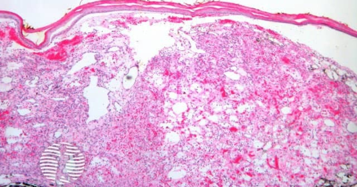Bacillary angiomatosis image