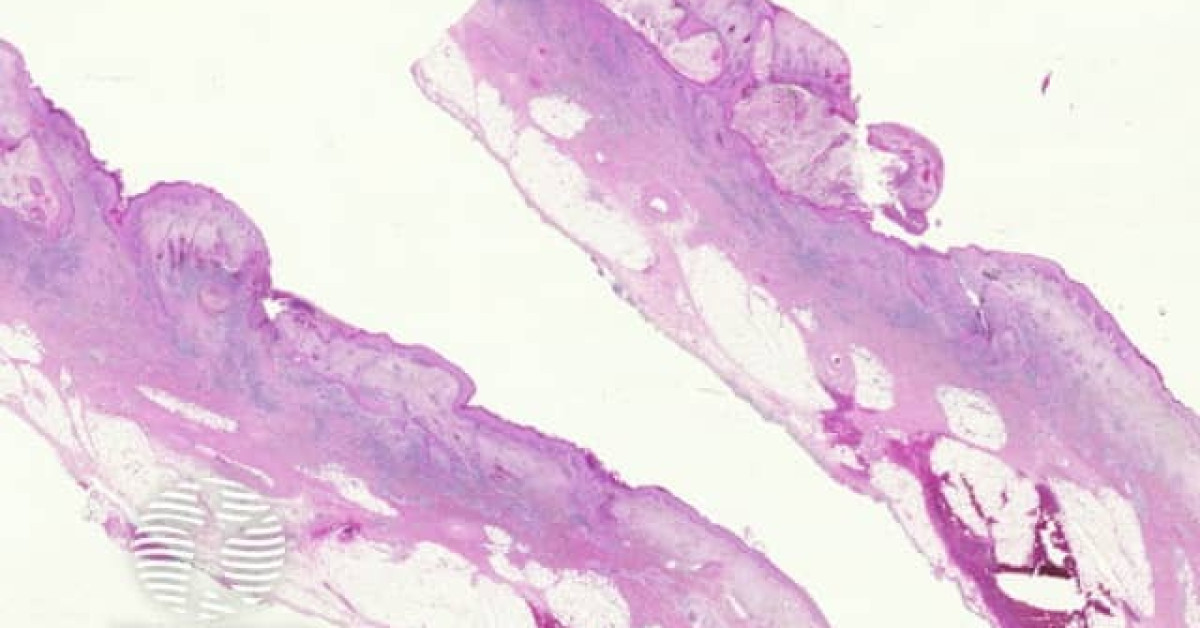 Blastomycosis-like pyoderma pathology image