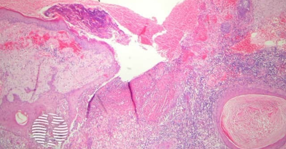 Blastomycosis-like pyoderma pathology image