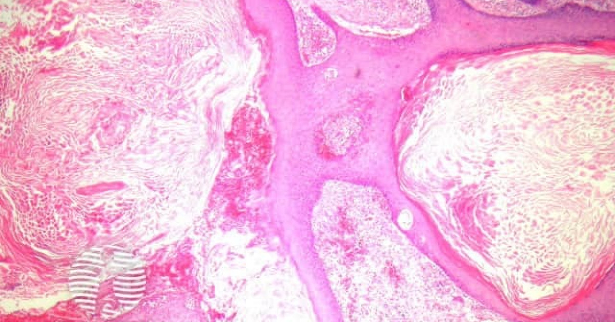 Blastomycosis-like pyoderma pathology image