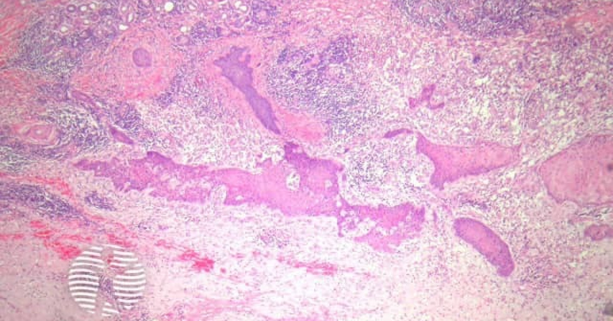 Blastomycosis-like pyoderma pathology image