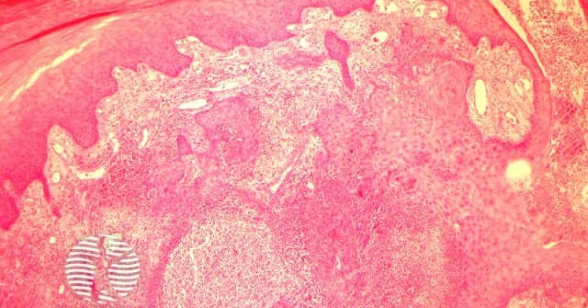 Botryomycosis pathology image