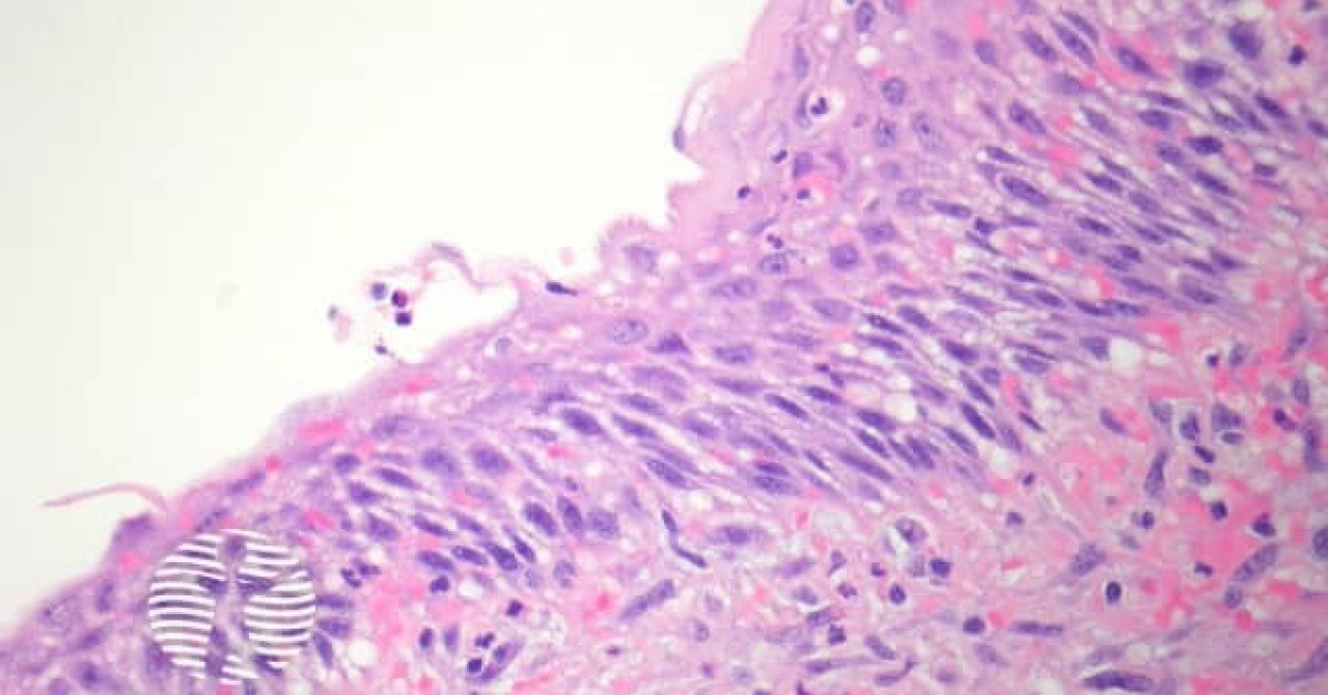Branchial cleft cyst pathology image