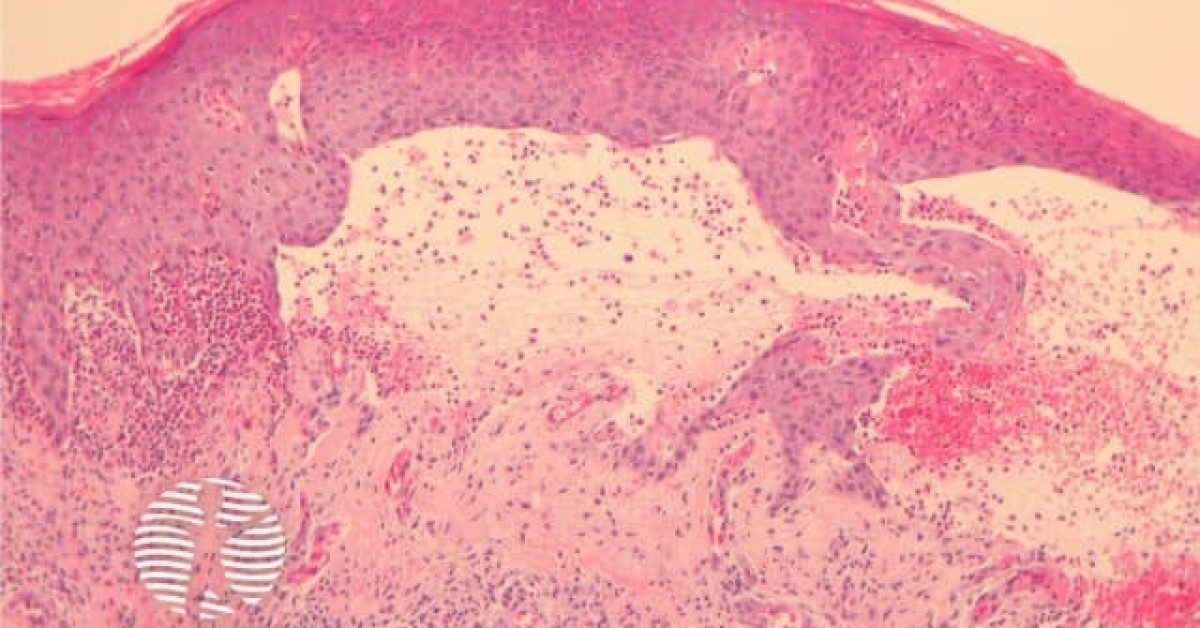Bullous pemphigoid pathology image